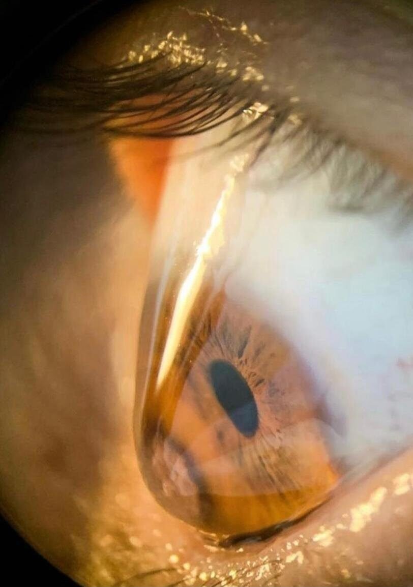 Ceratocone: Uma Visão Detalhada pela Lumiata Oftalmologia - Hospital de Olhos Vasconcelos Neto